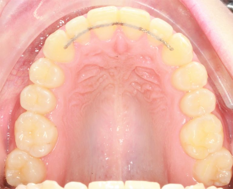 Retenedores fijos o removibles - Toda la información aquí